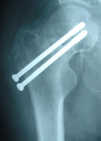 A Quick Guide to the Different Types of Orthopedic Screws