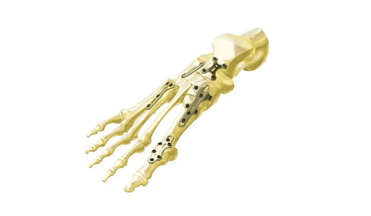 Choosing the Right Orthopedic Implants: A Practical Guide for Surgeons ...